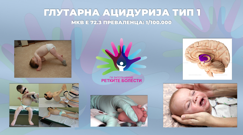Глутарна ацидурија тип 1 • WebOhrid